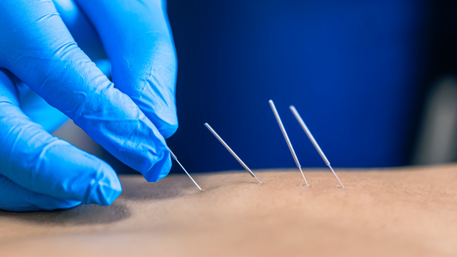 How Dry Needling Helps with Muscle Pain | Peake PT Blog