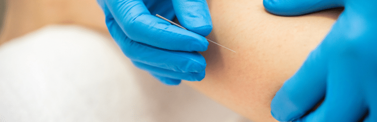 How Dry Needling Helps with Muscle Pain | Peake PT Blog
